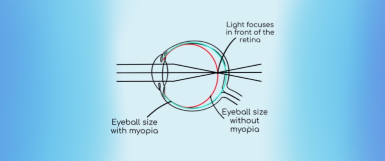 Myopia and Myopia Management – PB Opticians